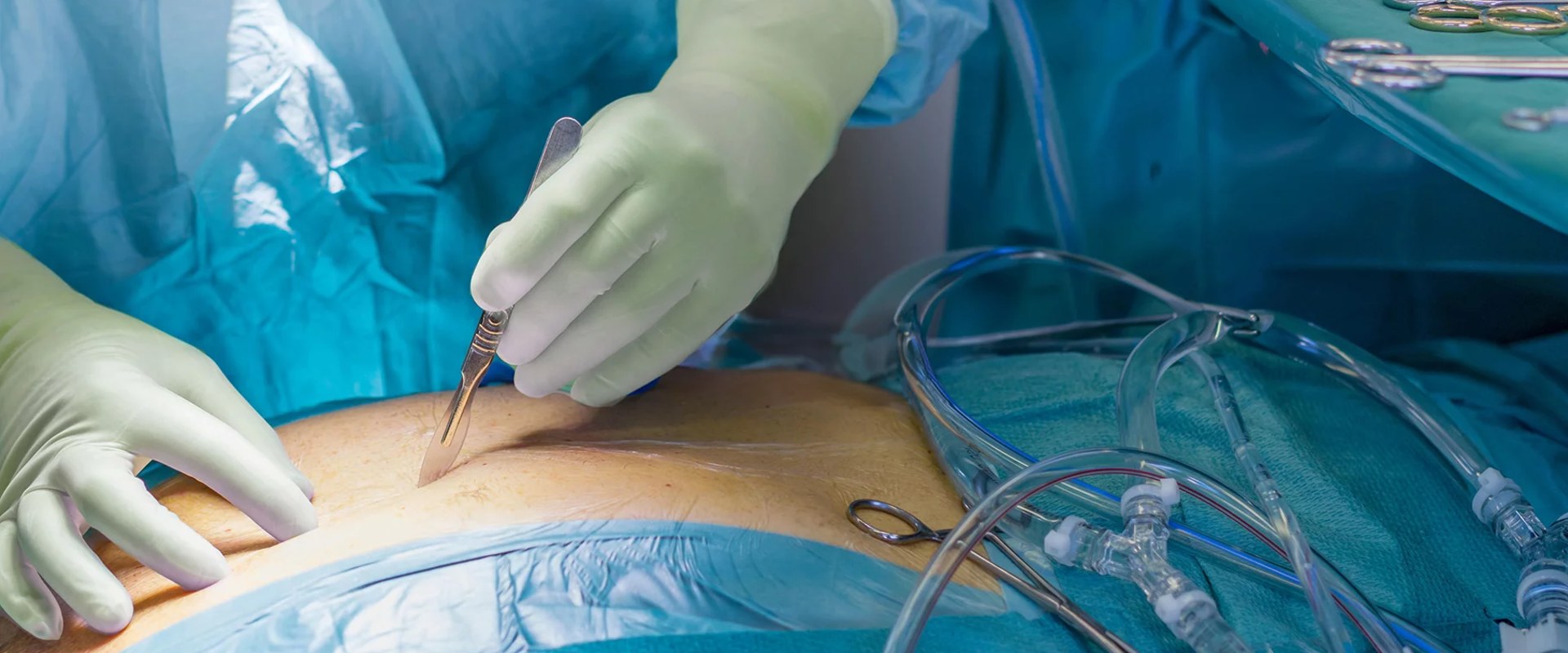 Proven Strategies for Successful Surgical Site Infection Wound Treatment