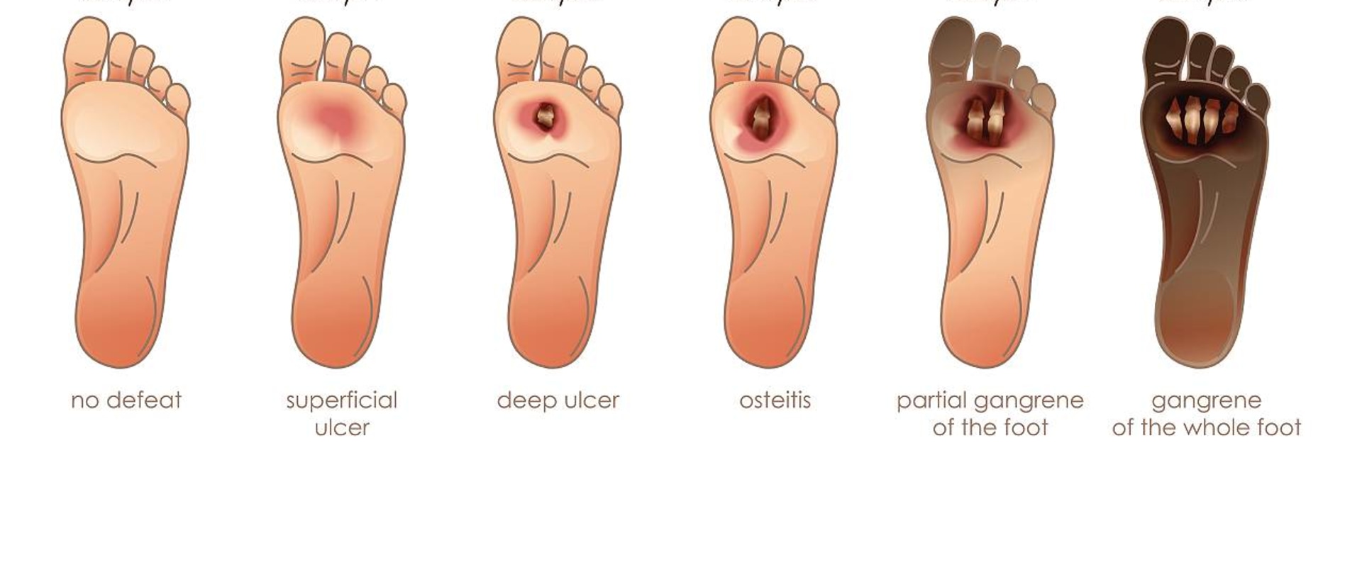 How To Identify And Manage Venous Ulcer Vs Arterial Ulcer Vs Diabetic