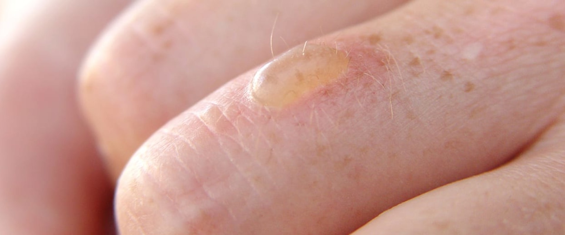 Effective Wound Treatment for 2nd Degree Burn Blister Healing Stages