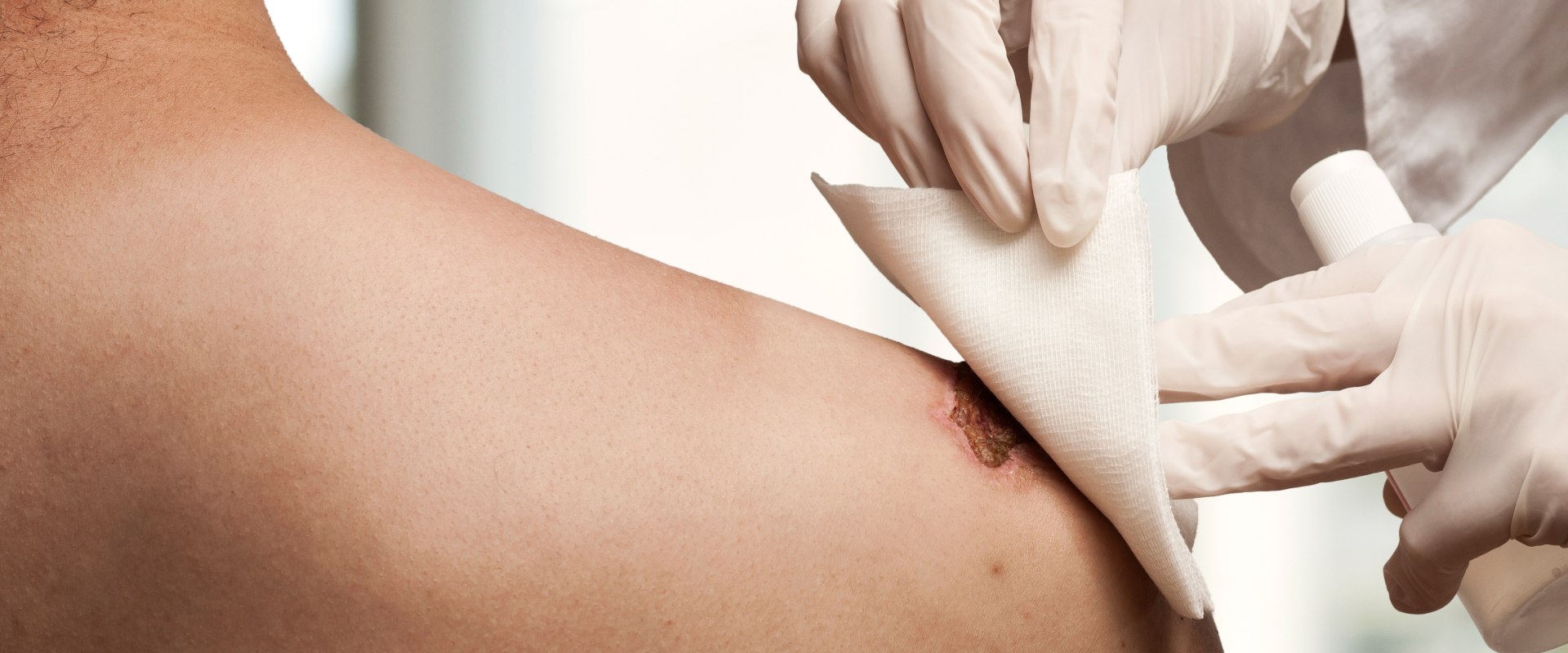 Navigating Your Treatment Options For A Denuded Skin Wound