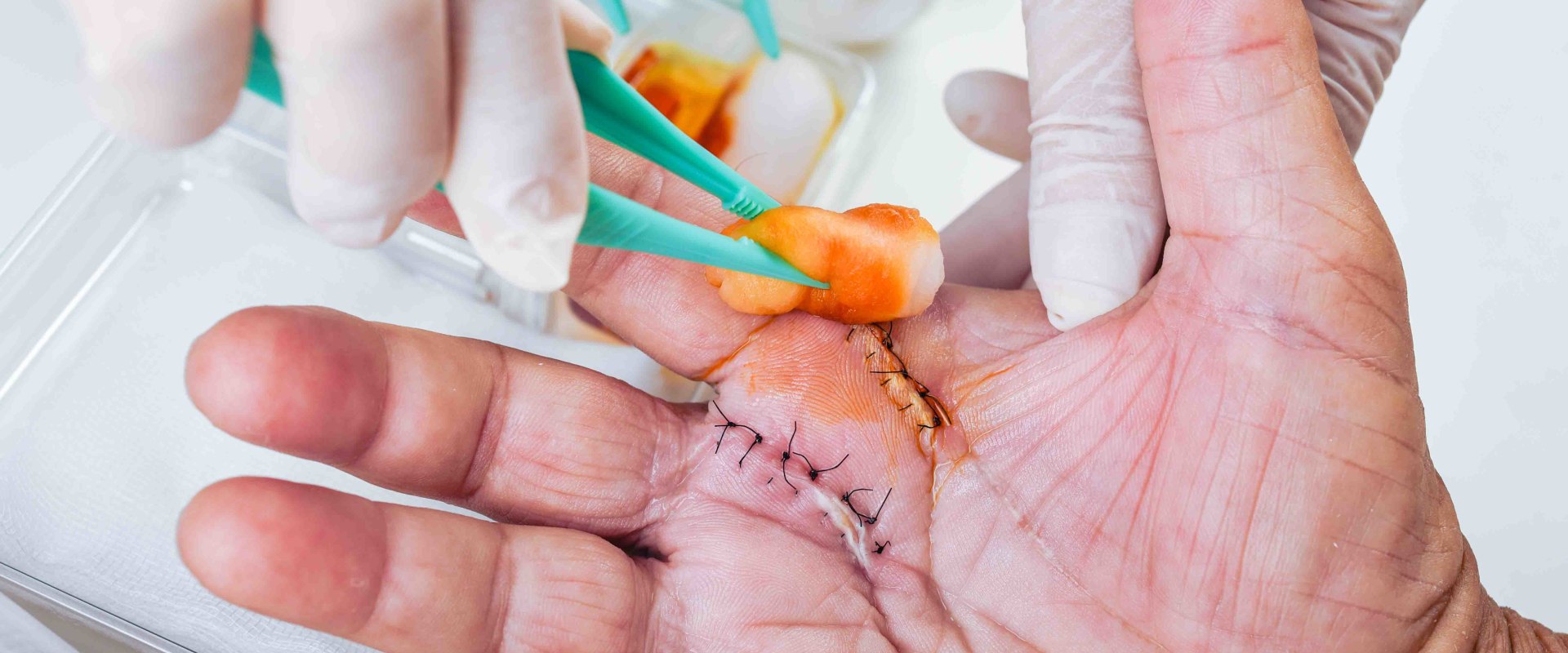 Granulation Tissue Pictures and Wound Healing Explained: What Healthy ...