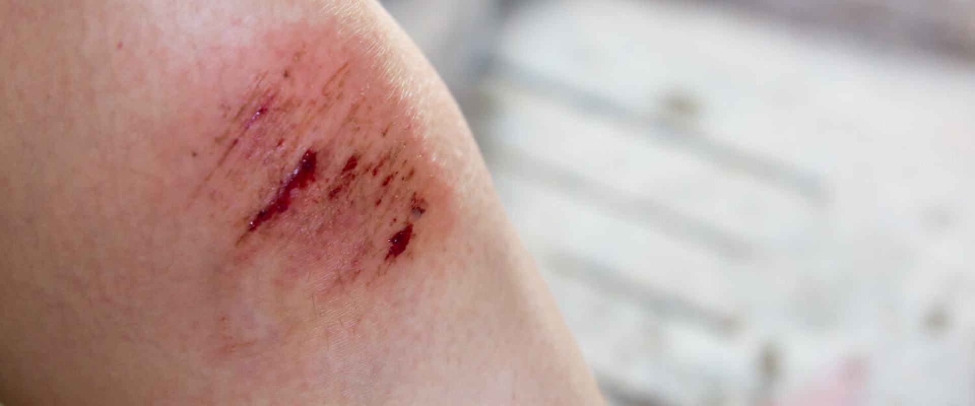 Edema Wound Treatment: Strategies For Healing And Managing Swelling