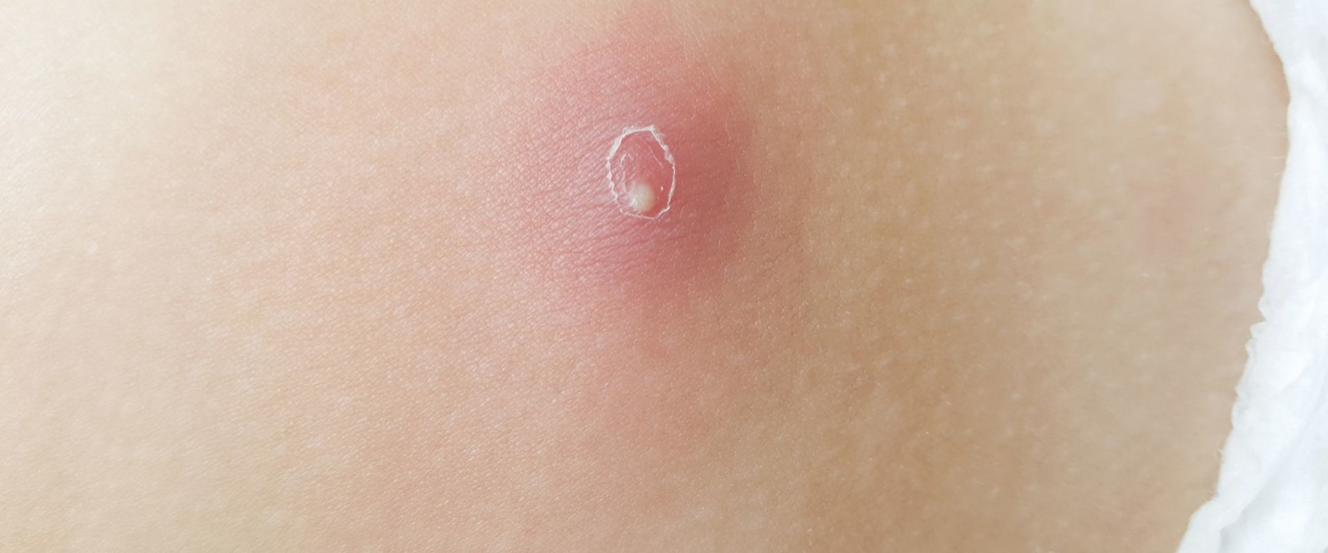 Boil vs Cyst vs Abscess: Causes, Symptoms & What to Do