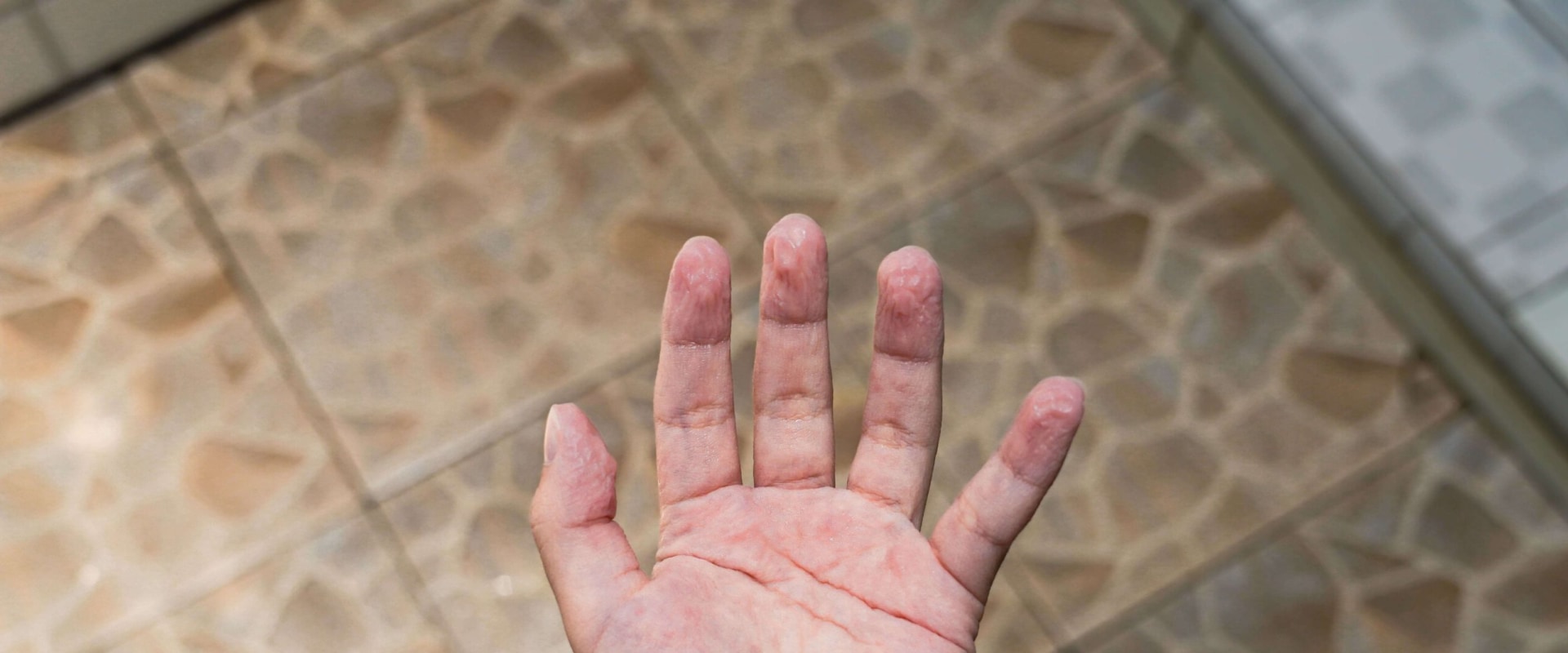 Effective Treatment Strategies For Macerated Skin Wounds