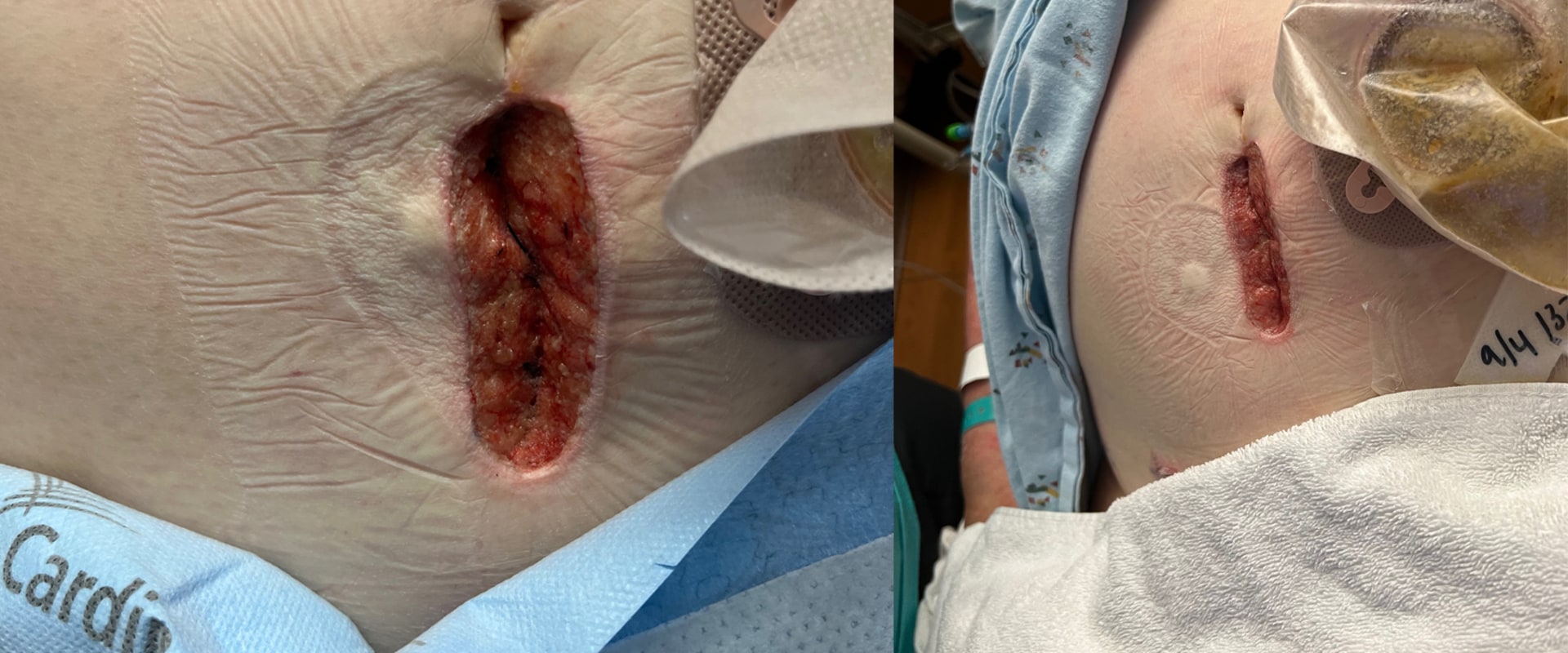 What Is Slough On A Wound? Best Practices For Wound Treatment