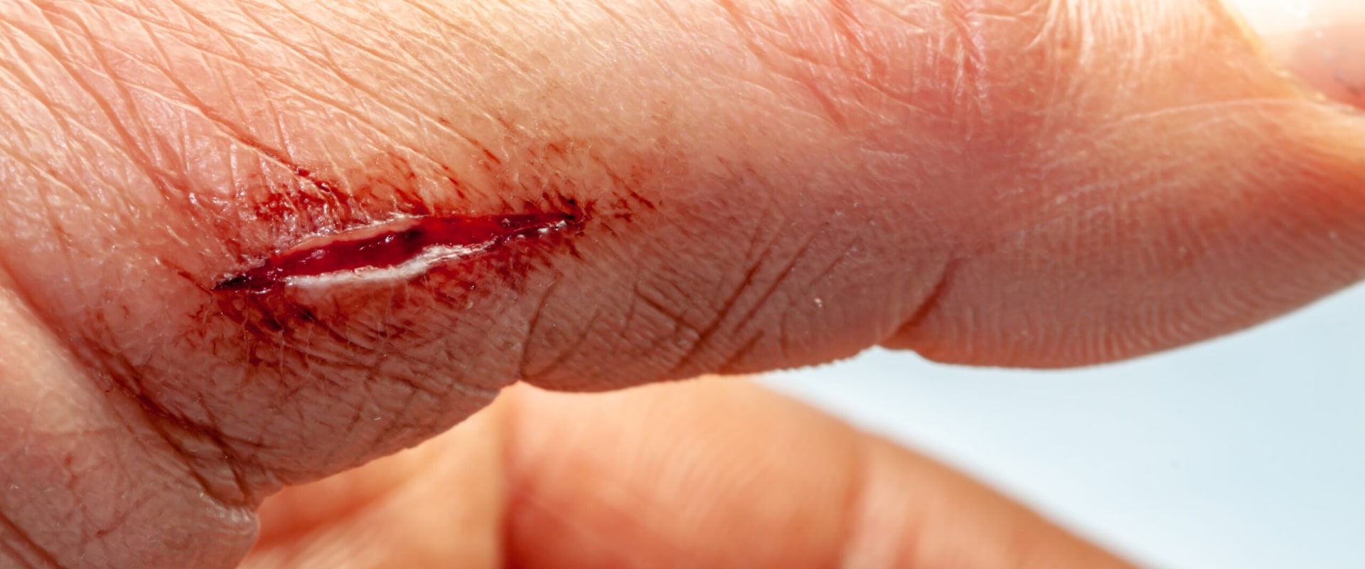 What Do Dissolvable Stitches Look Like? A Helpful Guide for Effective ...