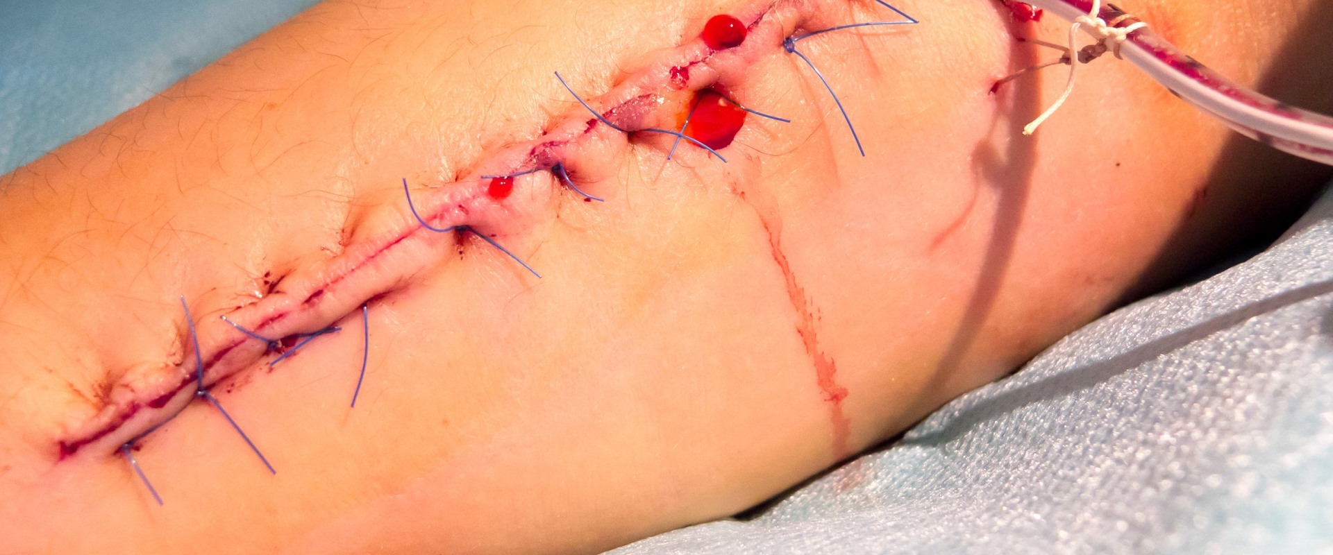 How to Navigate Normal Stitches Healing Stages With the Best Wound Care ...
