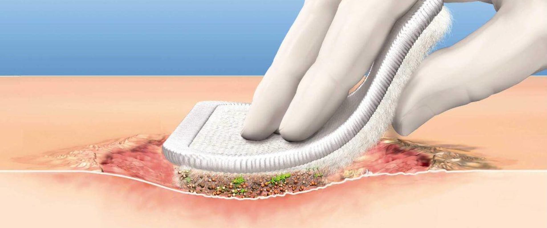 Moist Wound Healing Techniques That Take Your Wound Treatment To The ...