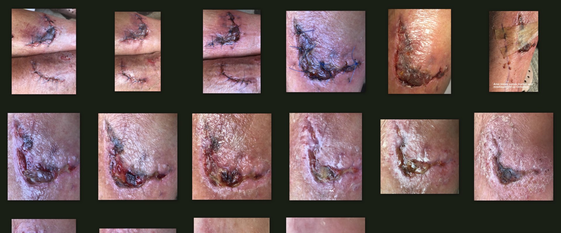 Mastering The Healing Stages For Surgical Wounds, Scars, And Stitches ...